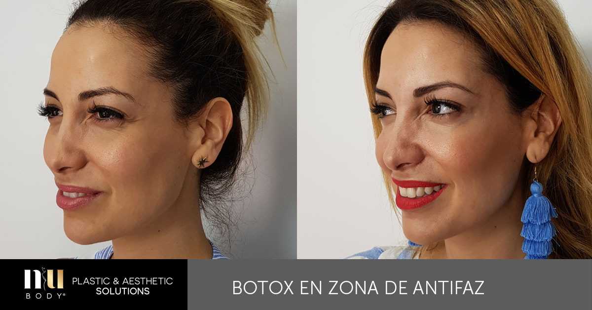 Galería Toxina Botulínica - nuBODY