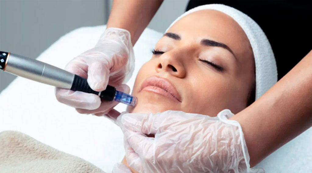 Dermapen: Rejuvenece tu piel con microagujas seguras | Nubody