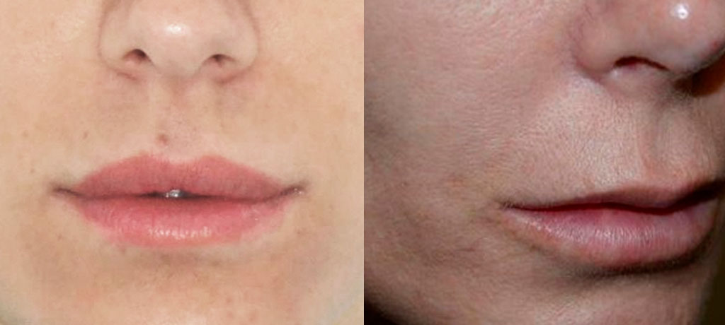 Lip Lift en Monterrey - nuBODY