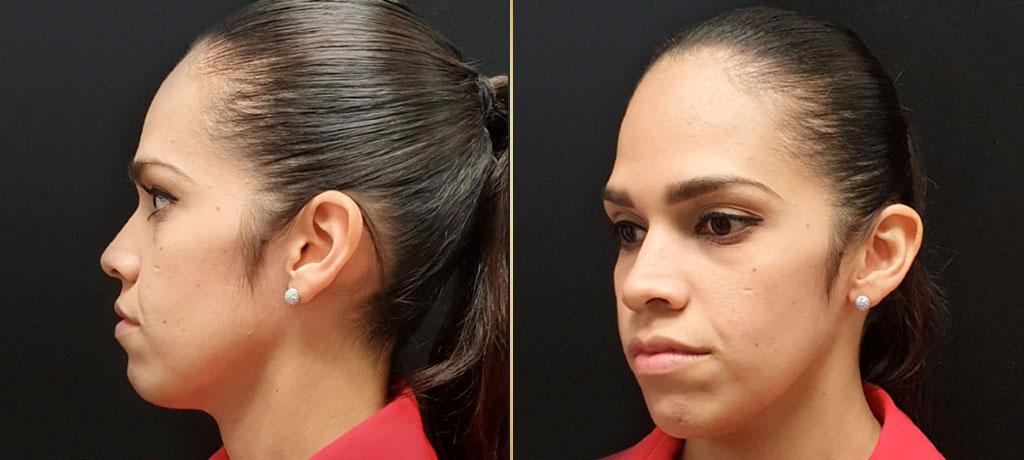 Liftherapy® - nuBODY