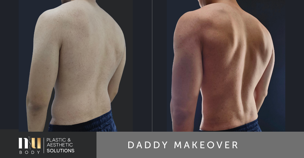 Galería Daddy Makeover en Monterrey - nuBODY