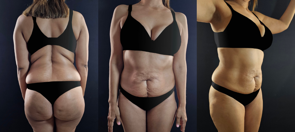 Lipectomia 360º circunferencial - nuBODY